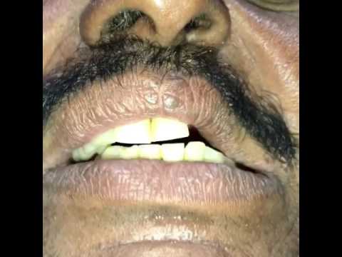 Obturator post maxillectomy