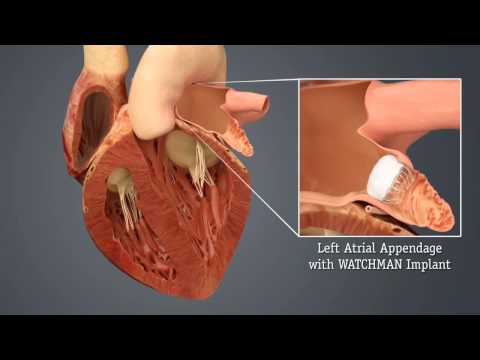 The WATCHMAN™ Left Atrial Appendage Closure Device