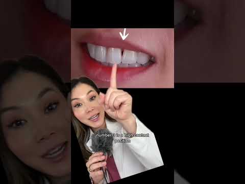 The dreaded black triangle and how to get rid of it. #blacktriangle #dentist #dentistry #filling
