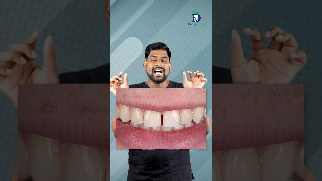 பல் நடு இடைவெளி சரி செய்வது ஏன் கடினம்? Why midline diastema closure is difficult? Dr.Karthikeyan