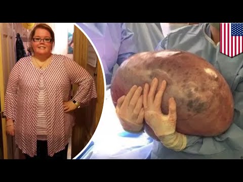 Giant 50 pound cyst removed from Alabama woman's ovary - TomoNews