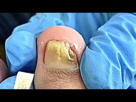 The process of treating onychomycosis, gentle【DT Pedicure】
