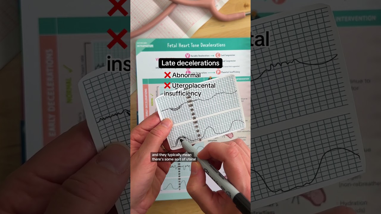 Fetal Heart Strips Explained 🍼🩺💖 #RN #BSN #futurenurse