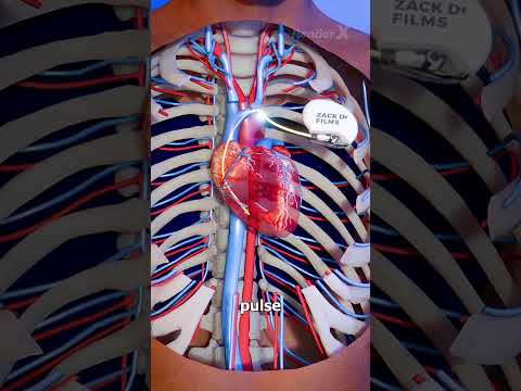 What is Pacemakers ??