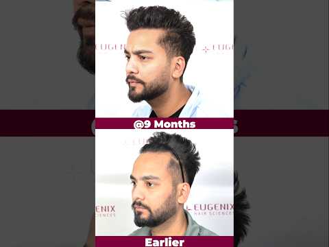 Elvish Yadav Hair Transplant Results: Must See Before & After Transformation! #hairtransplant