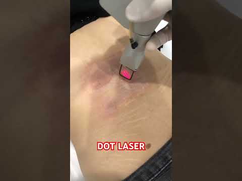 Stretch Mark Removal | 1 Aesthetic Plastic Surgery