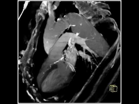Vascular: Ascending Aortic Aneurysm evaluated with both 3D and 4D reconstructions(2 of 5)