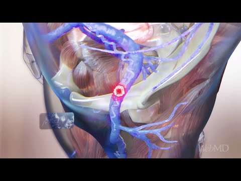 What Deep Vein Thrombosis Looks Like | WebMD