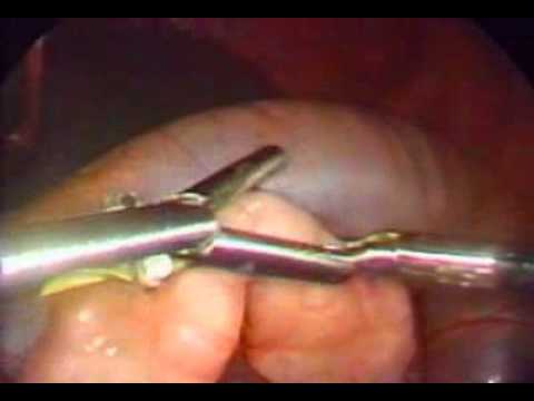 Laparoscopic Choledochal Cyst Excistion with Roux-en-Y Hepaticojejunostomy