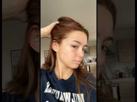 MY EXPERIENCE WITH GUTTATE PSORIASIS #shorts