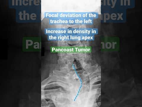 Pancoast tumor🫁 #radiology #xray #medical