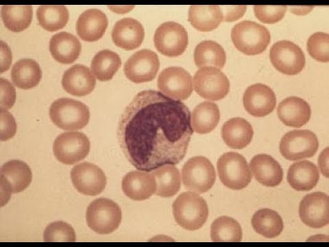 Pediatric Immune Thrombocytopenia Purpura