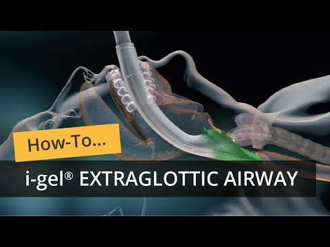 Igel Insertion – Combat Medicine 101