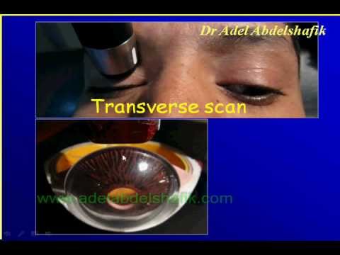 Basics of ophthalmic US and UBM