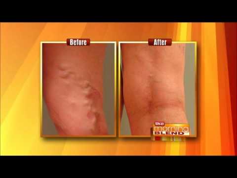 Dr. Manjoney on The Morning Blend - The Difference Between Spider Veins and Varicose Veins