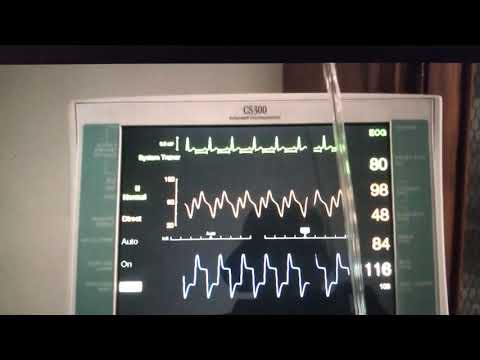 Datascope CS300 Balloon Pump
