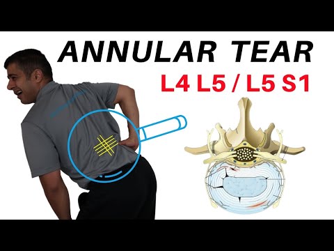 Annular Tear L4L5 L5S1 Disc Bulges