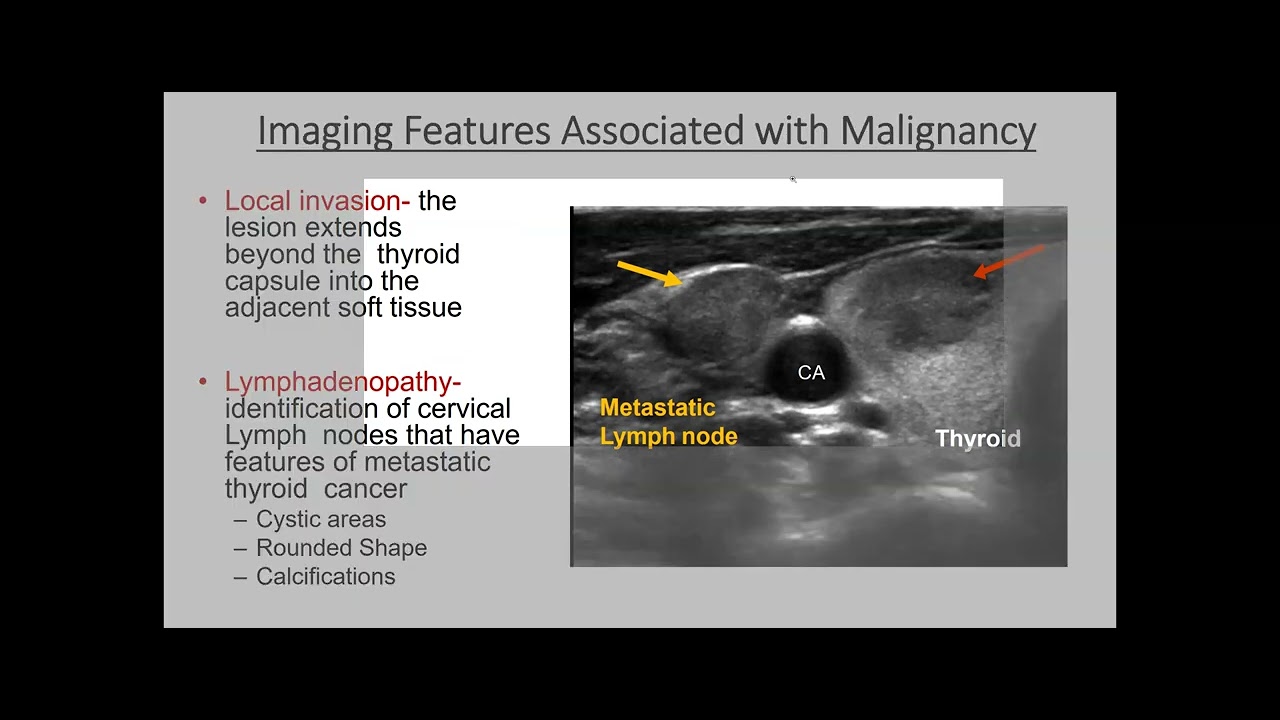 Surgical Pathology and Cytology of the Thyroid – Benign and Malignant