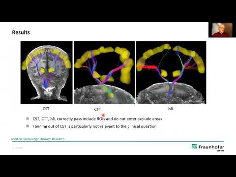 Jürgen Jenne: Automated and Generalized Definition of Target in TcMRgFUS for Tremor Therapy