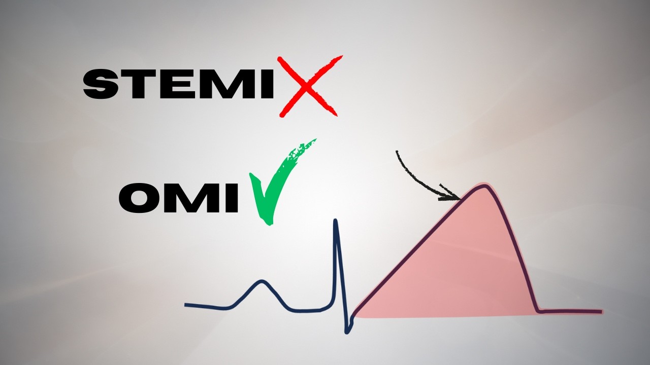 Recognizing an OMI (Subtle STEMI) on a 12 lead