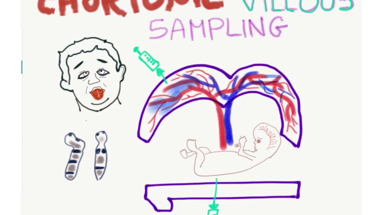Chorionic Villus Sampling (CVS) Mnemonic