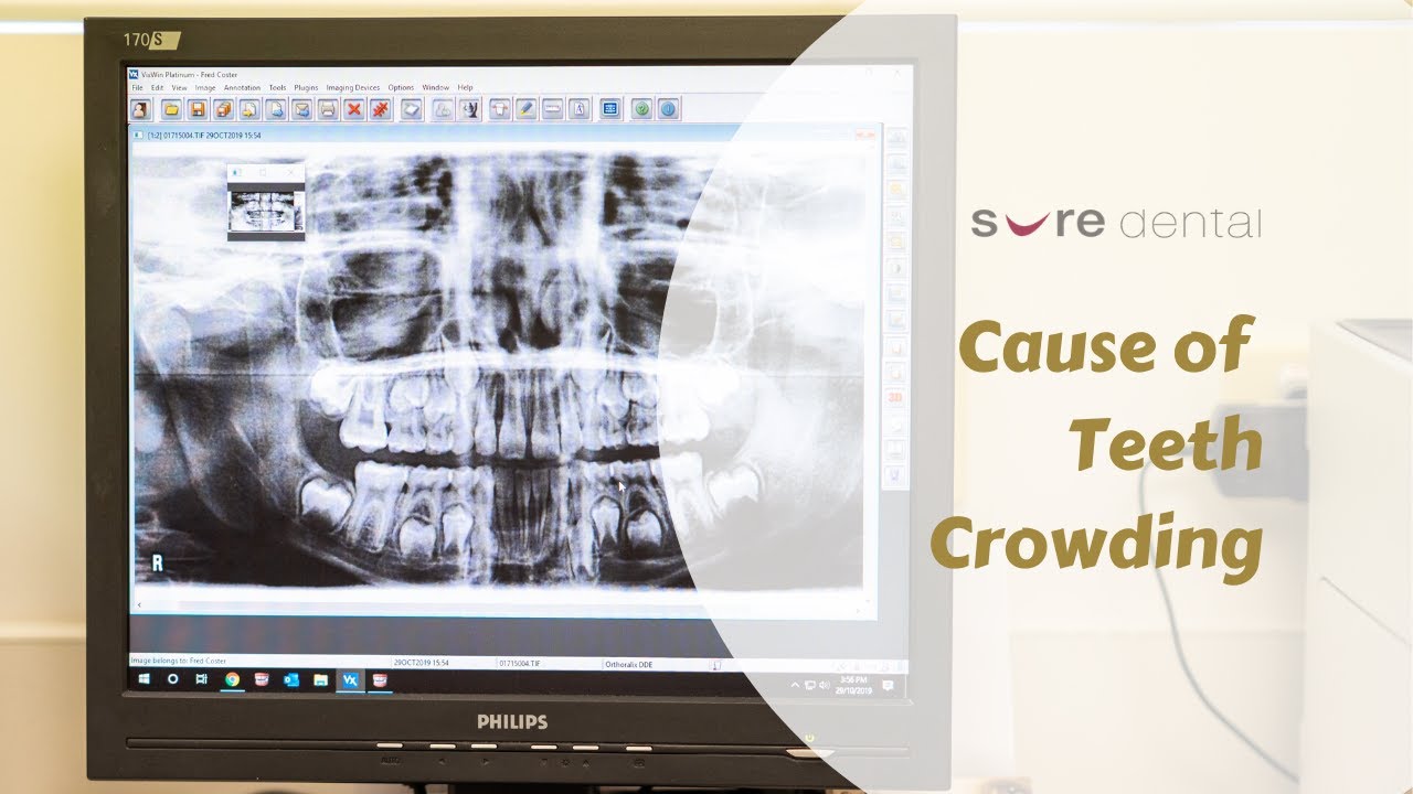 What Causes Teeth Crowding