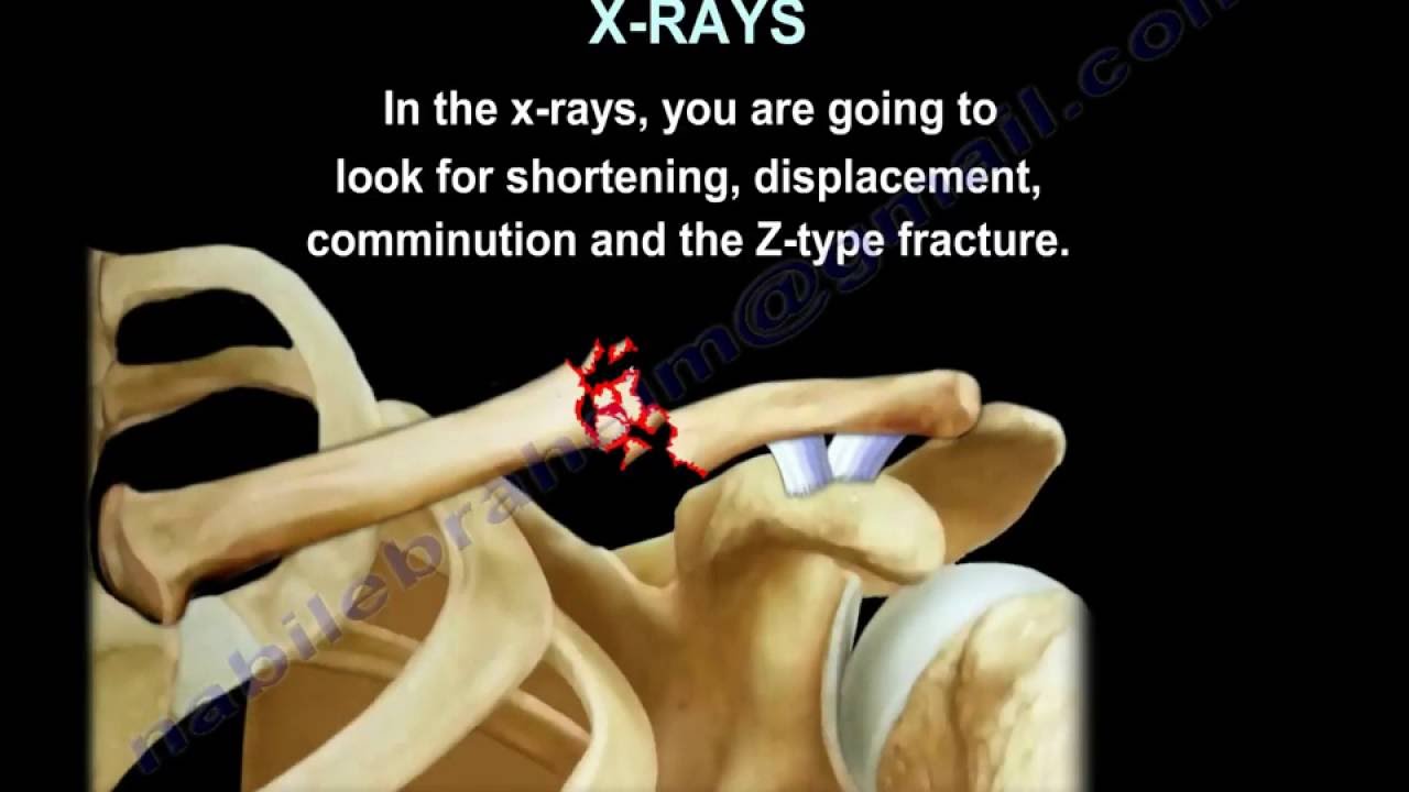 Clavicle Fractures - Everything You Need To Know - Dr. Nabil Ebraheim