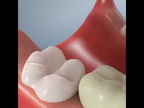 Fissure Sealant
