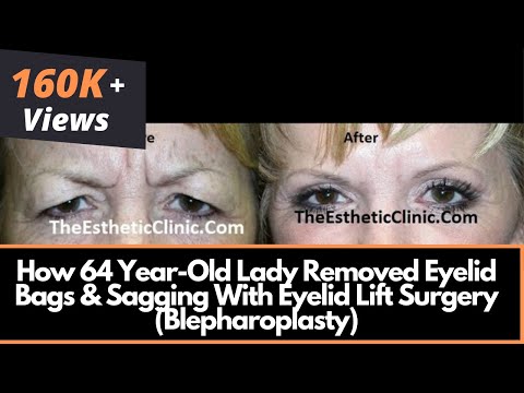 How 64 Year-Old Lady Removed Eyelid Bags & Sagging With Eyelid Lift Surgery (Blepharoplasty)