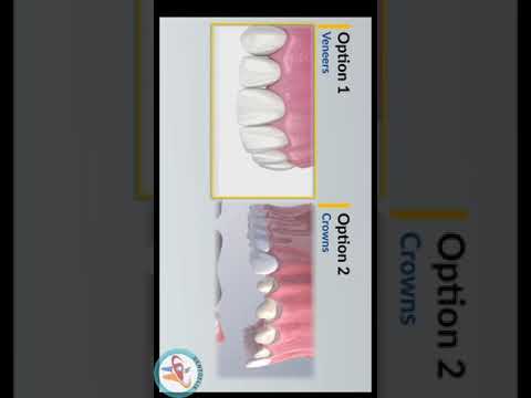 Veneers vs Crowns on Front Teeth || Difference between Veneers and Crowns || Veneers Procedure