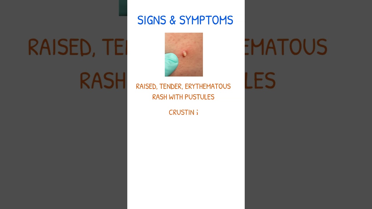 FOLLICULITIS SIGNS & SYMPTOMS