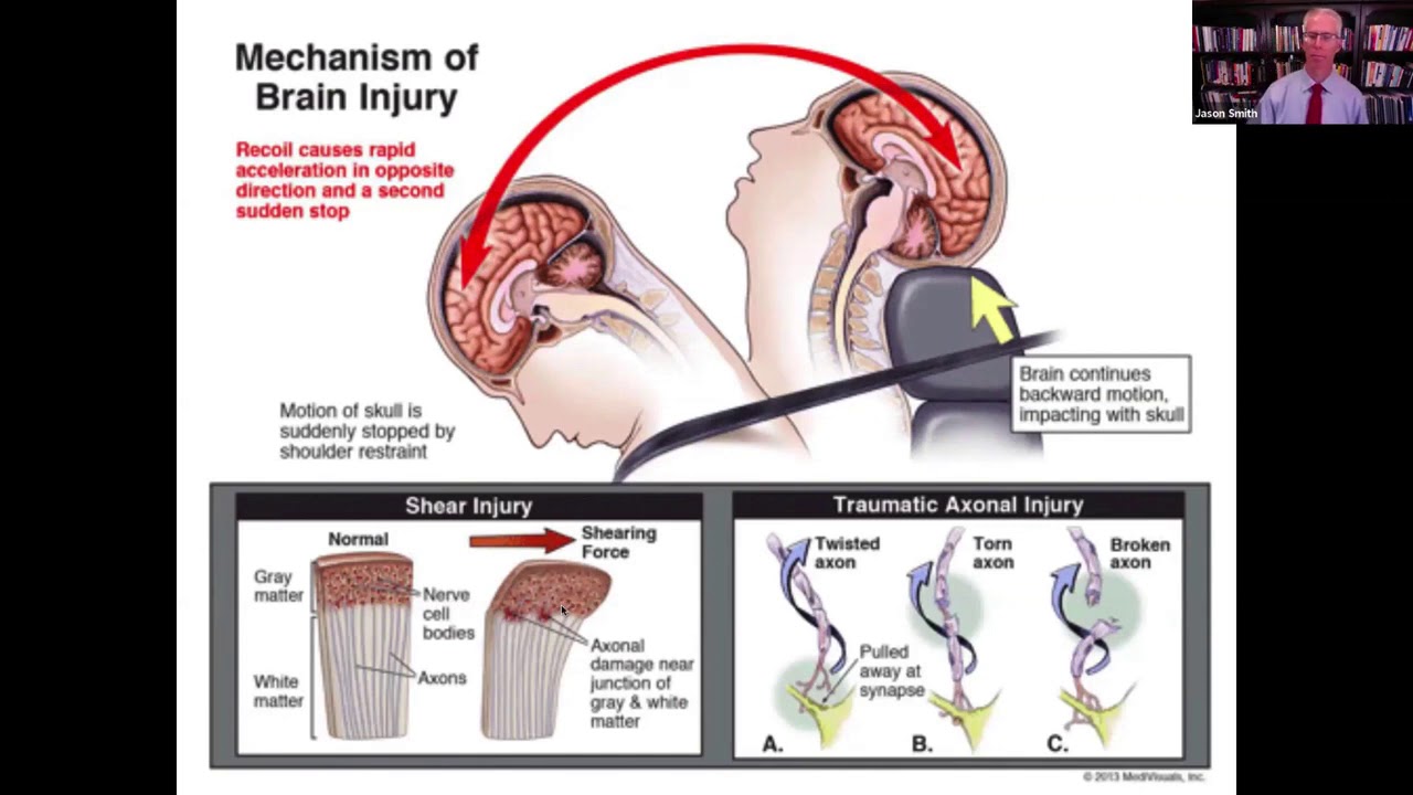 Cervical Spine Instability and TBI - Dr. Jason Smith - IAFNR 2020