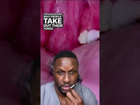 Why Do You Take Out Tonsil Stones? #shorts