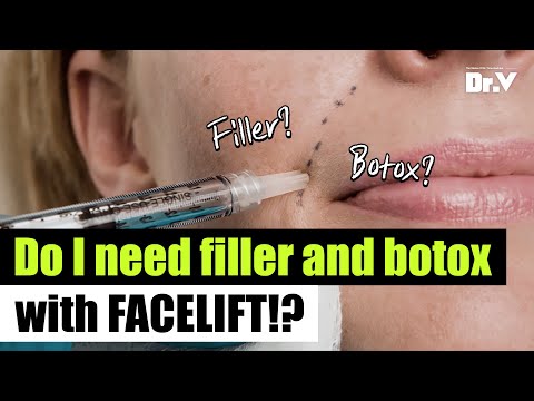 Facelift FAQ) Is it a must to get botox or filler together with a facelift?
