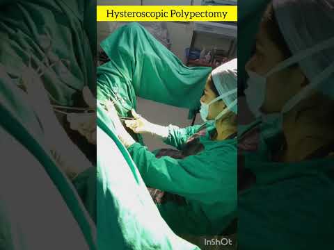 Hysteroscopic Polypectomy by Dr Rakshita Malik #doctor #gynaecologist #mbbs #medicalstudent #shorts
