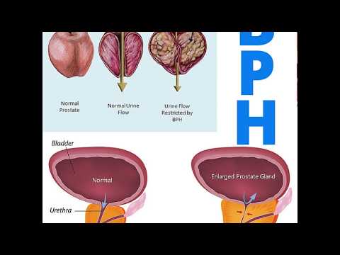 What is BPH? Benign Prostatic Hyperplasia Explained - Dr. David Samadi