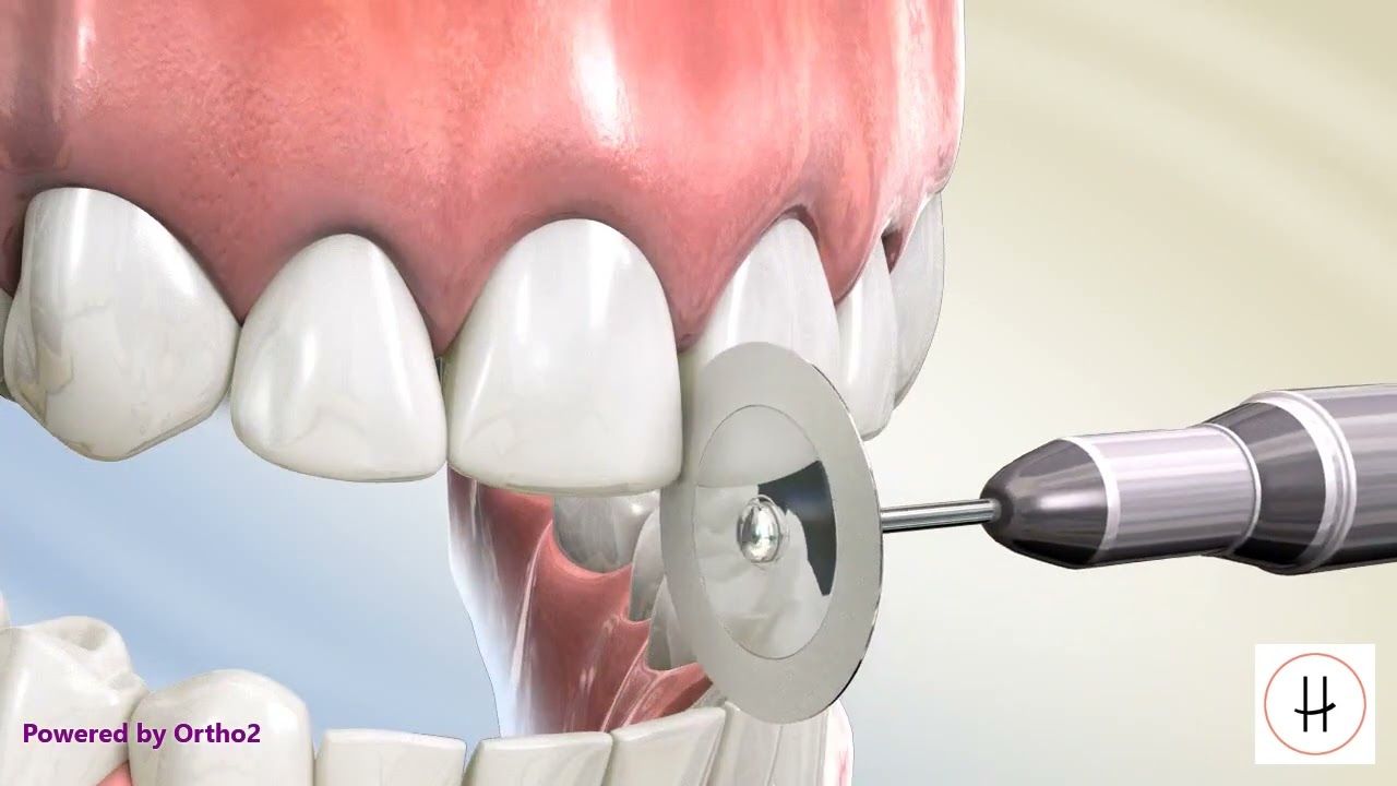 Interproximal Reduction for Dark Triangle | High Line Orthodontics | New York, NY