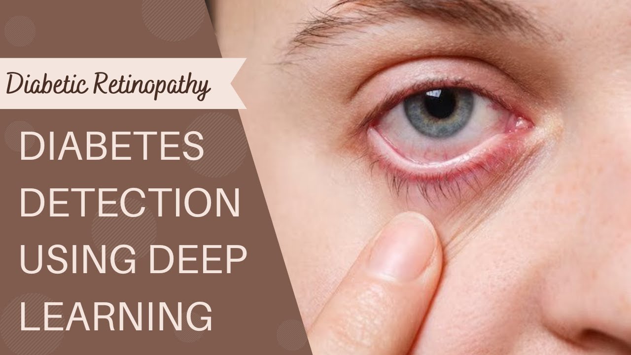 AE076 | Diabetes Detection Using Deep Learning