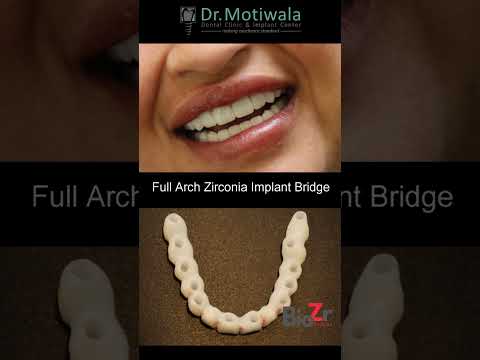 Full Arch Zirconia Implant Bridge | Smile in 3 Days #drmotiwala