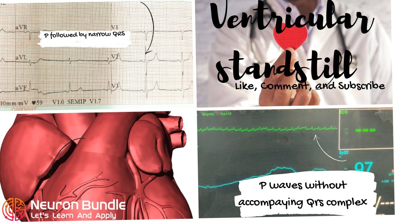 Ventricular standstill l a rare ECG abnormality I heartblock |  #arrhythmia  #cardiology