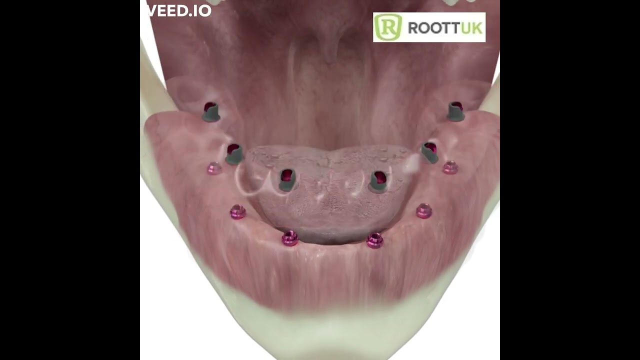 How to use ROOTT M - Screw retain prosthesis (in 2 patient visits)