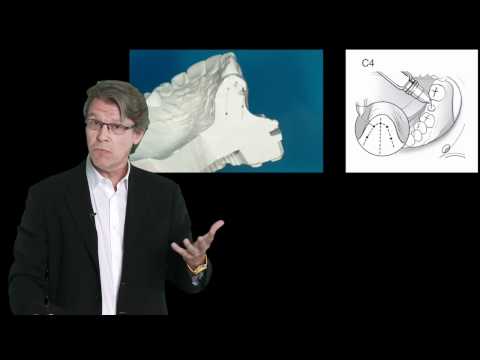 187-00 The 3D Click Guide - A New Direction for Model-Based Guided Implant Placement PREVIEW