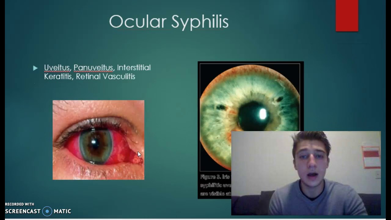 Syphilis Powerpoint