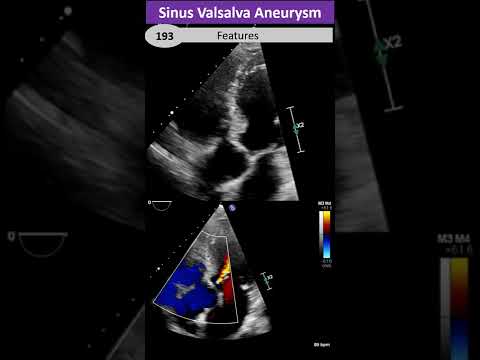 Sinus Valsalva aneurysm