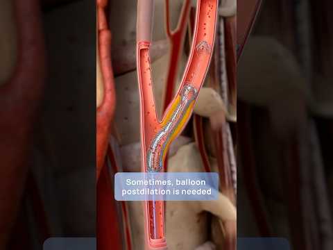 How carotid stenting prevents stroke: a step-by-step 3D guide to restoring blood flow