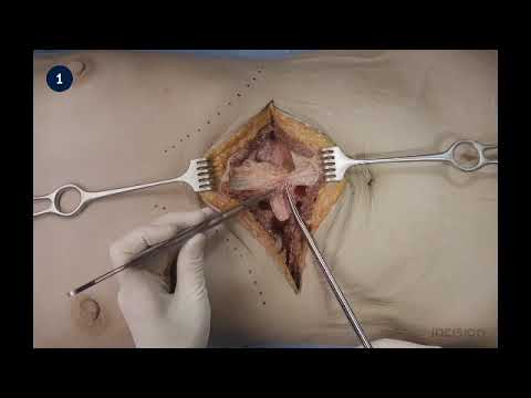 Abdominal Wall Incision