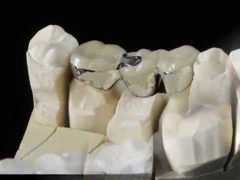 Stress Breaker PFM Bridge, Udell Dental Laboratory – Udell Dental ...
