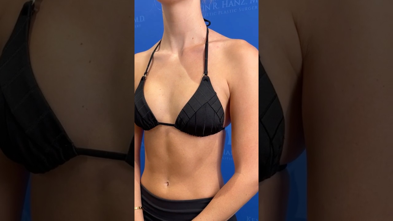 1 year post-op results! Ballerina Breast Augmentation #ballerinaimplants #boobjob #beforeandafter