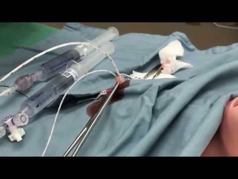 Umbilical Catheter - umbilical artery catheter Latest Price ...