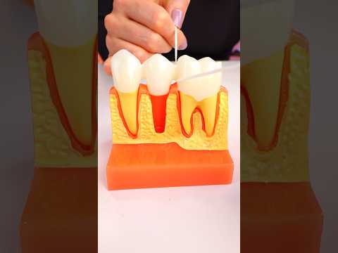 How To Floss Under A Bridge